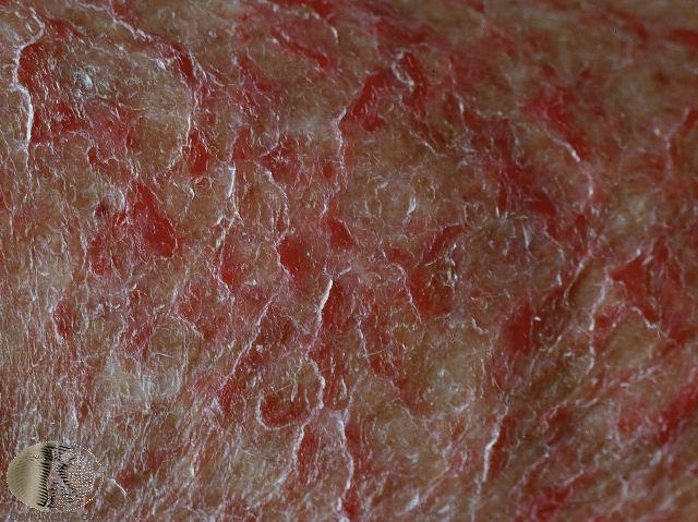 DERMATOLOGY TEACHING ONLINE: ECZEMA