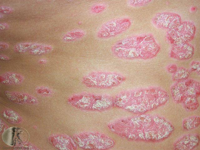 DERMATOLOGY TEACHING ONLINE: FUNGI AND INFESTATIONS