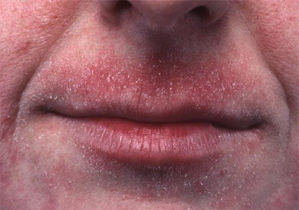 UK Diagnostic Criteria for Atopic Dermatitis