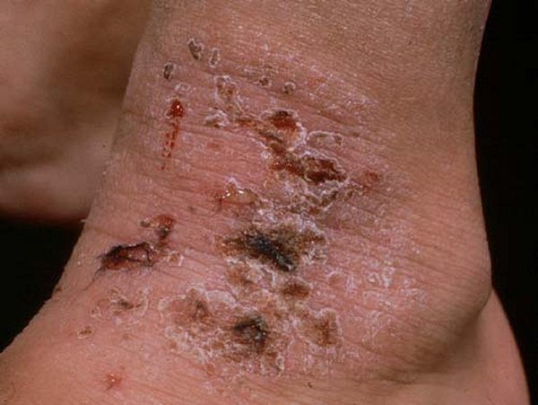 UK Diagnostic Criteria for Atopic Dermatitis