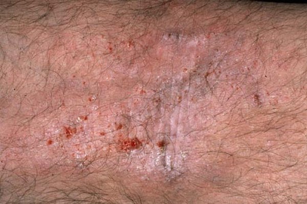 UK Diagnostic Criteria for Atopic Dermatitis