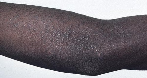 UK Diagnostic Criteria for Atopic Dermatitis