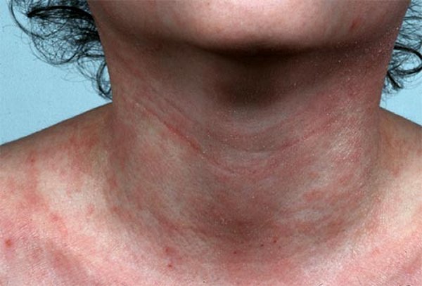 UK Diagnostic Criteria for Atopic Dermatitis