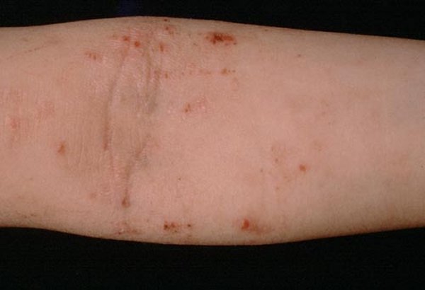 UK Diagnostic Criteria for Atopic Dermatitis