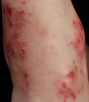 UK Diagnostic Criteria for Atopic Dermatitis
