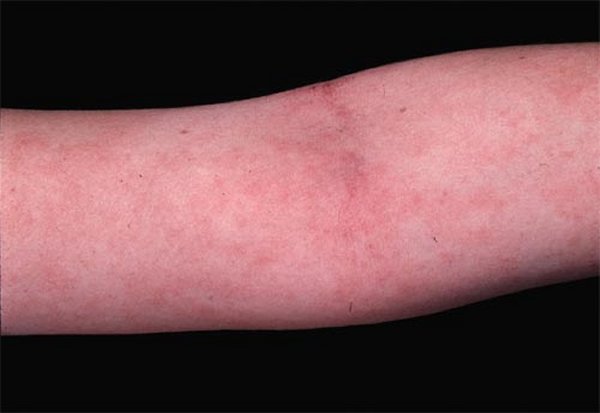 UK Diagnostic Criteria for Atopic Dermatitis