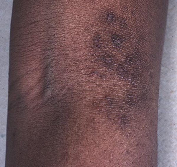 UK Diagnostic Criteria for Atopic Dermatitis